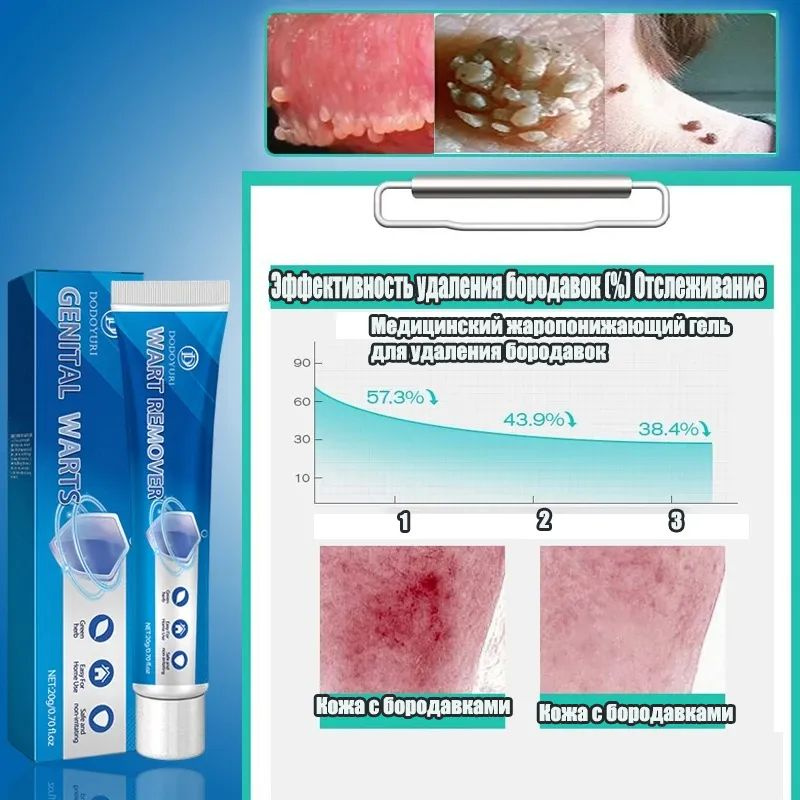 DODOYURI / Мазь от бородавок, Крем средство для удаления бородавок ...