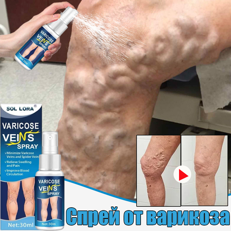SOL LORA Спрей от варикоза, усталости и отека ног 30ml Эффективно лечит отек и боль в ногах ...
