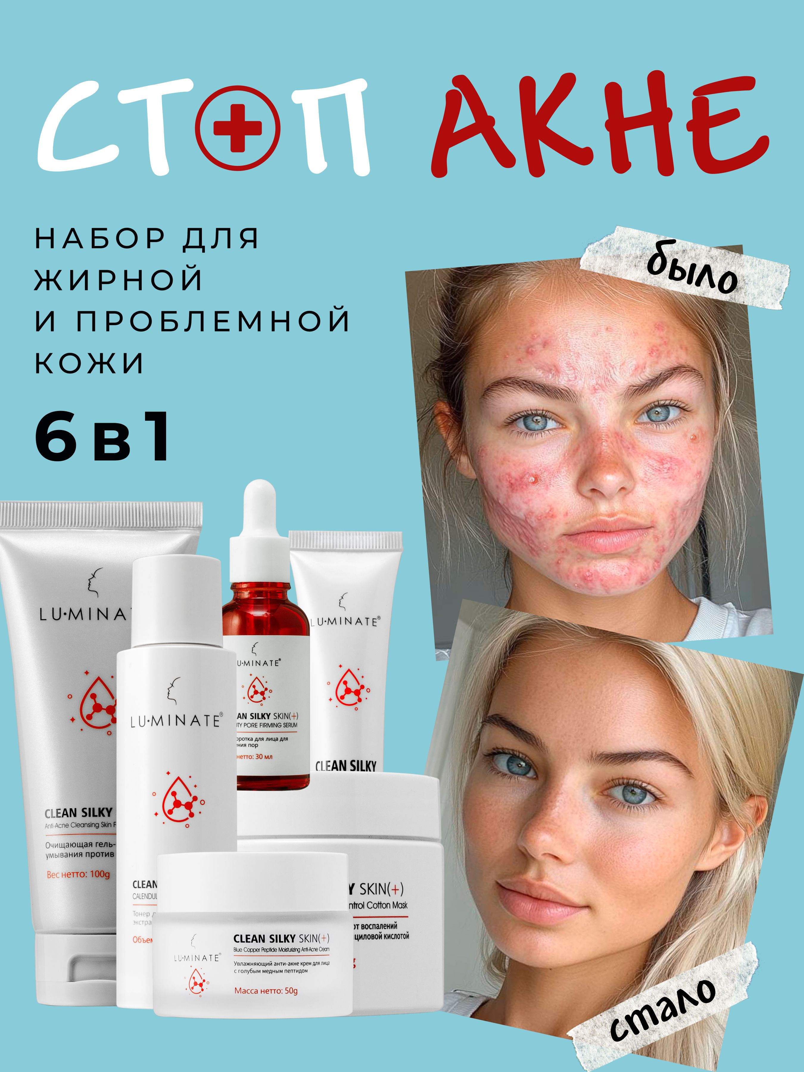 LU MINATE Набор косметики от прыщей анти акне с салициловой кислотой ...