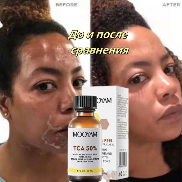 Химический пилинг TCA 50%, 7 дней Супер сильный кислотный пилинг кожи Tca, пигментация, шрамы от ...