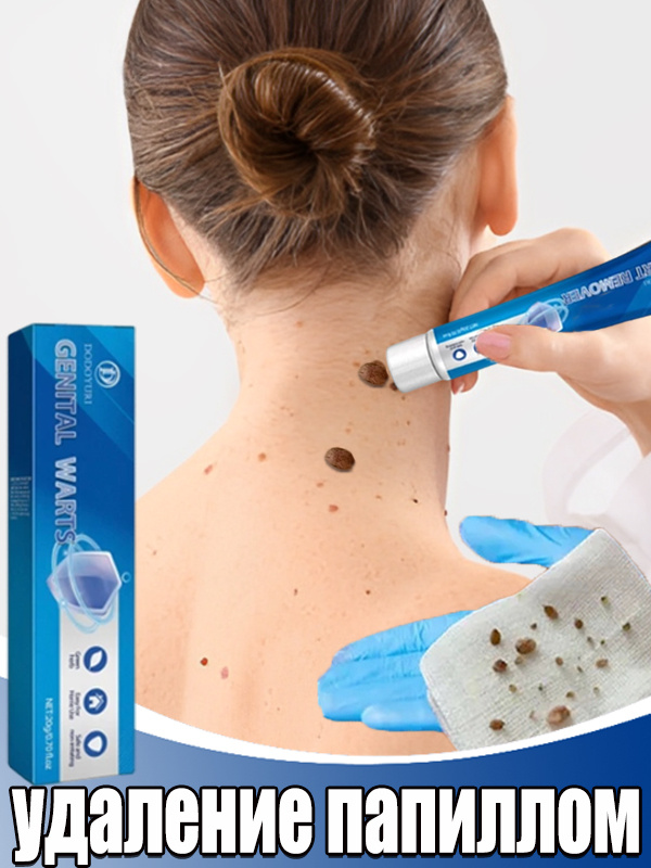 DODOYURI средство от бородавок Крем для удаления бородавок и родинок от ...