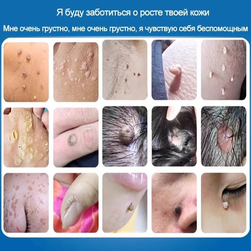 DODOYURI средство от бородавок Крем для удаления бородавок и родинок от ...