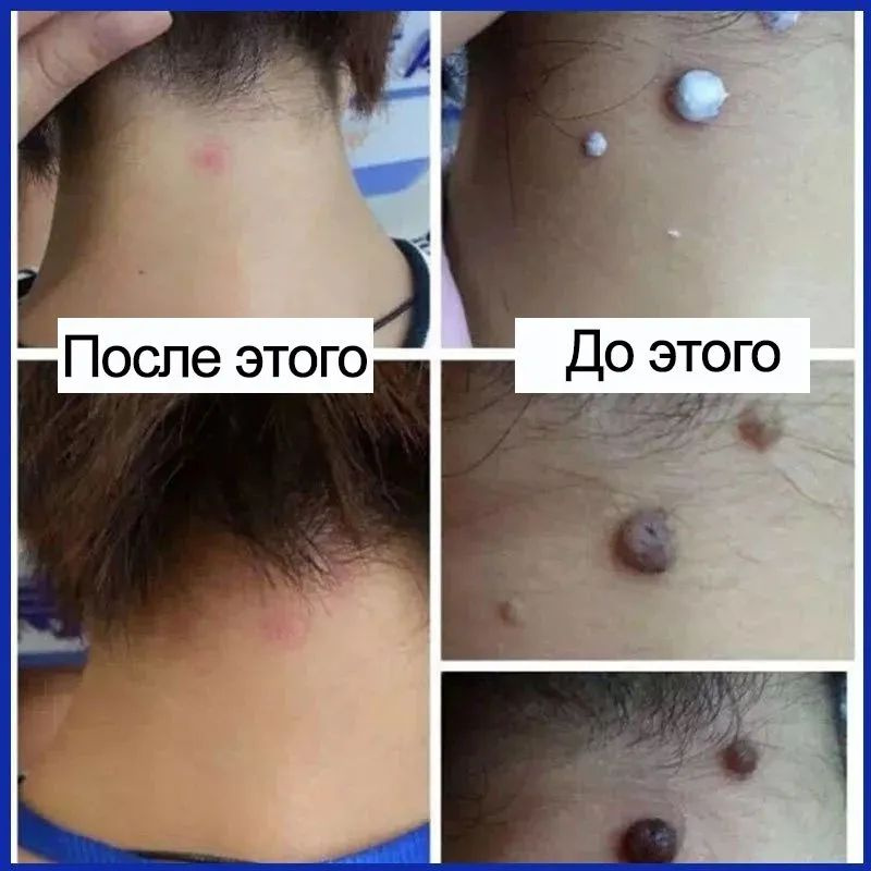 DODOYURI средство от бородавок Крем для удаления бородавок и родинок от ...