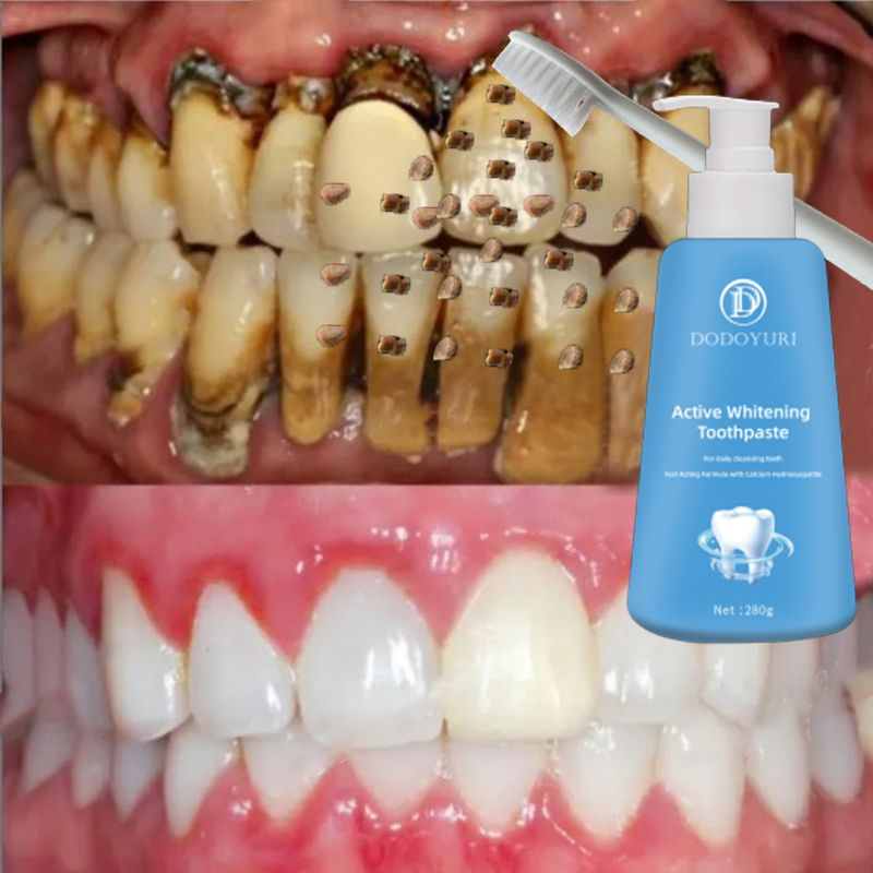 DODOYURI отбеливание зубов зубная паста отбеливающая, устранить желтые ...