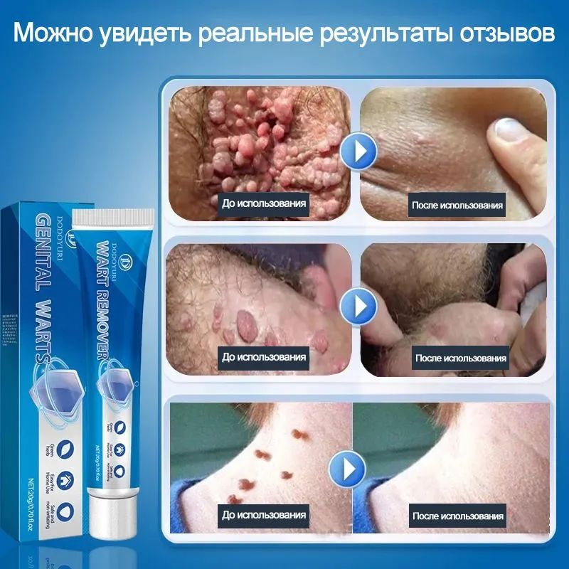 DODOYURI средство от бородавок Крем для удаления бородавок и родинок от ...