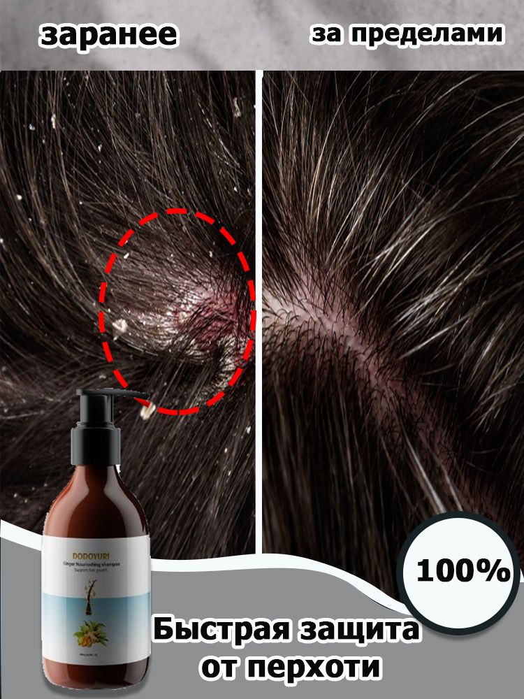 DODOYURI, мощный шампунь против перхоти, для борьбы с перхотью, зудом и ...
