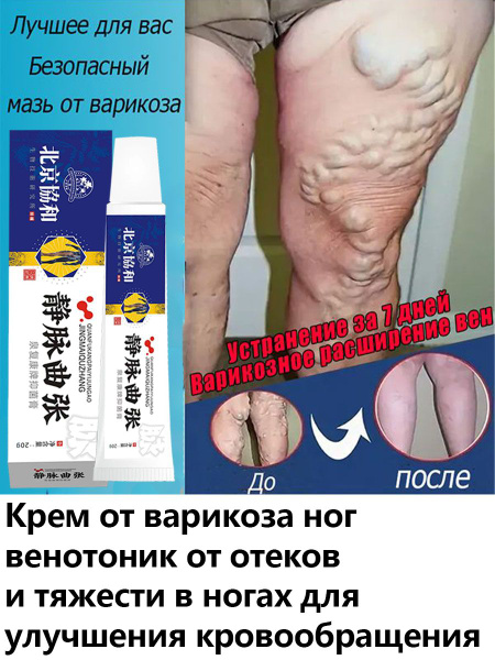 Крем от варикоза ног, венотоник от отеков и тяжести в ногах, для ...