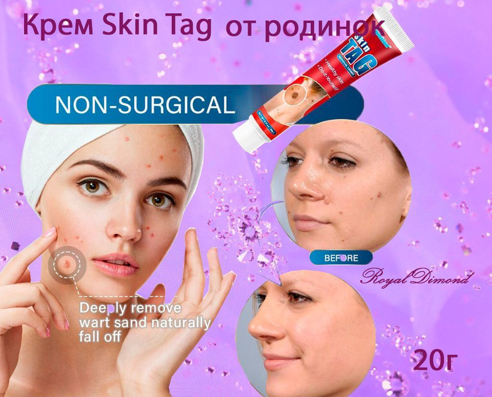 Мазь от родинок, Skin tag - купить с доставкой по выгодным ценам в ...