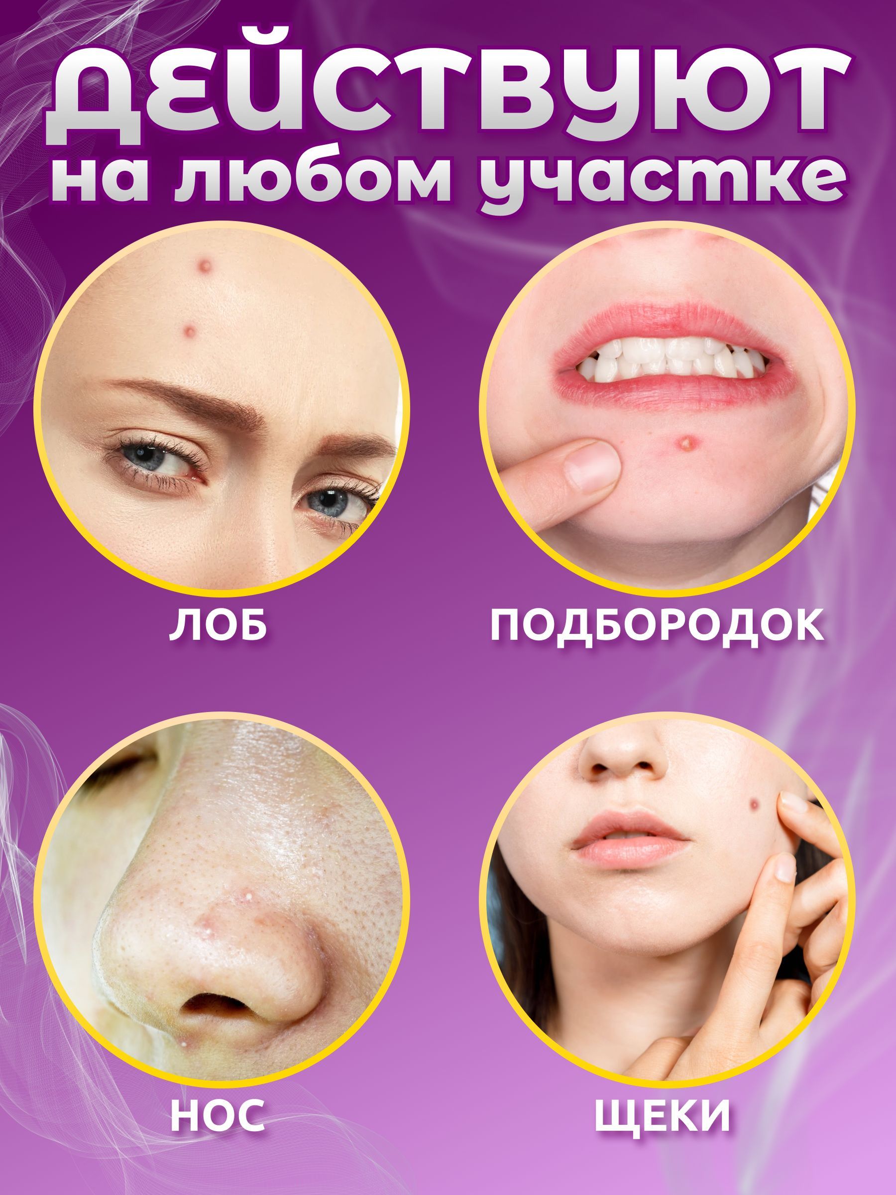 Прозрачные патчи-стикеры наклейки лечебные от прыщей, угрей и акне ...