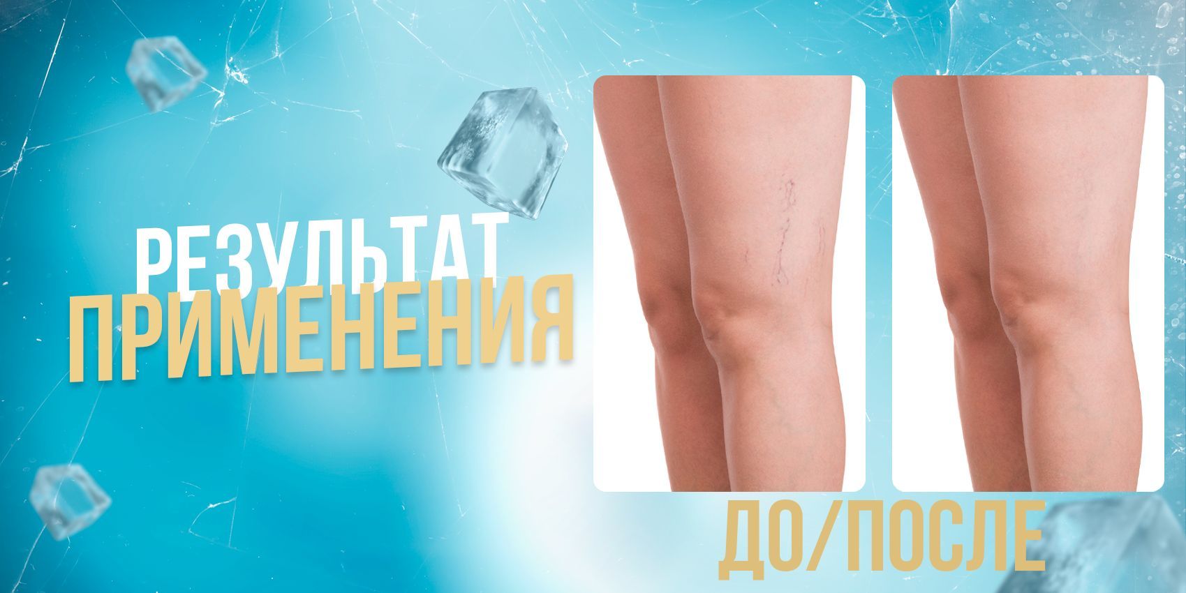 ROYAL DUMOR HERB / Гель от варикоза, крем для ног, от отеков, для вен ...