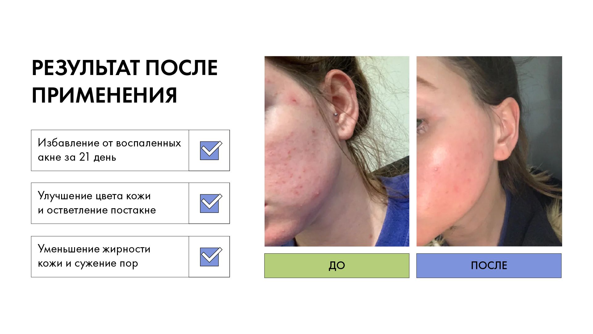 БьютиЦевтика Лосьон с салициловой кислотой от прыщей + набор для ...