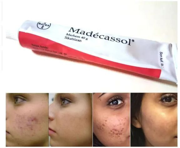 Мадекассол (Madecassol) крем, Средство от отметок, 40гр купить на OZON ...