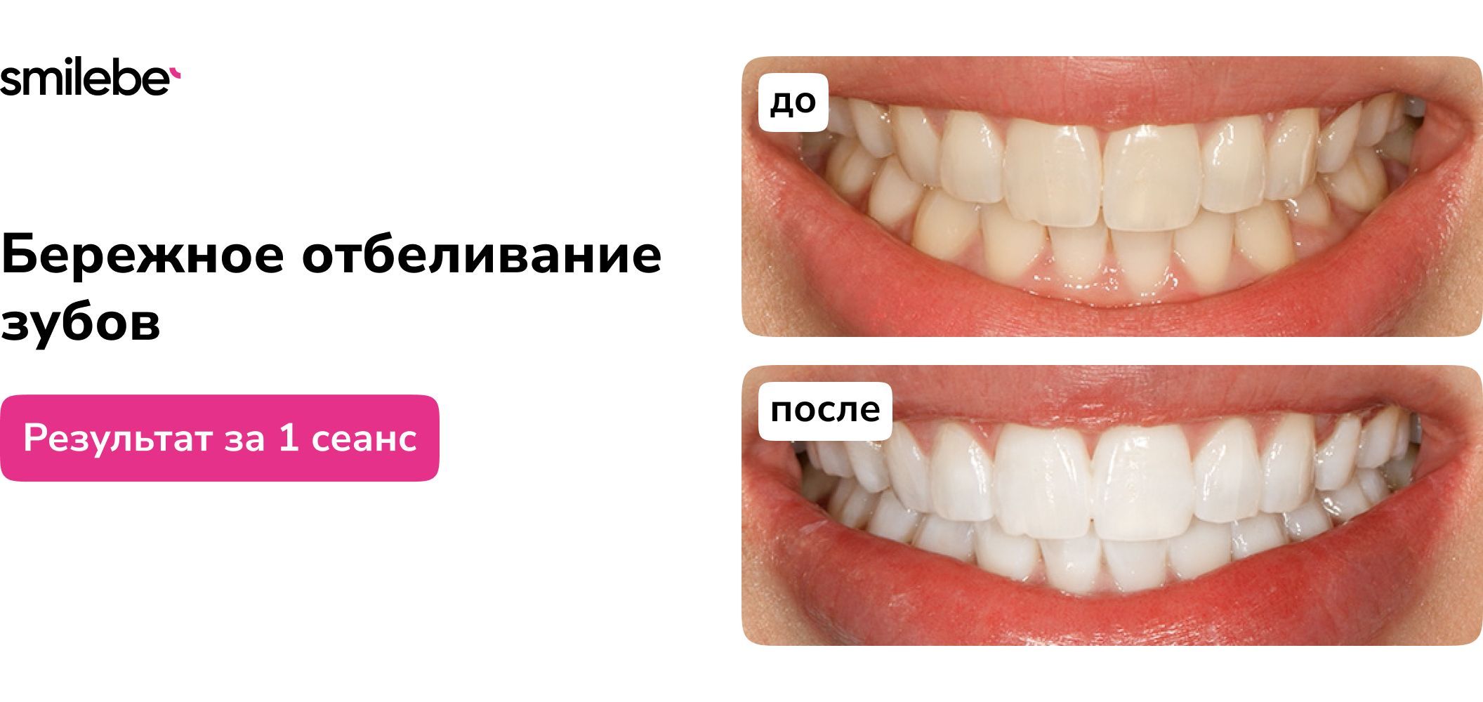 Отбеливающие полоски для зубов Smilebe, 28 полосок на 14 дней. Teeth ...