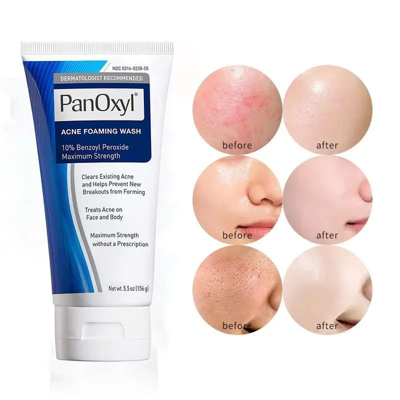 PanOxyl, Пенка для умывания от акне, перекись бензоила 10% максимальной ...